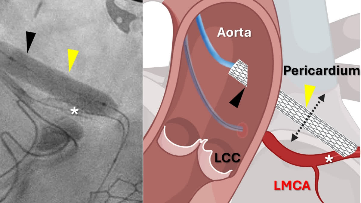 Scientists In Atlanta Achieve World's First Minimally Invasive Coronary ...