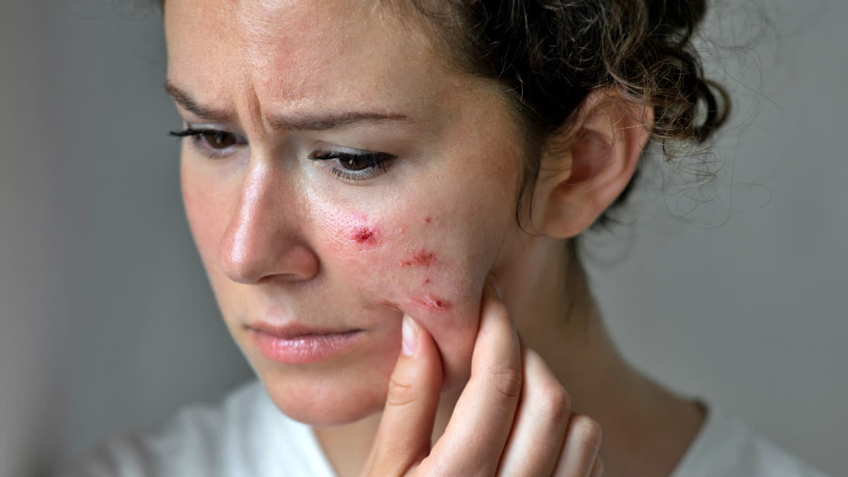 The Gut-Skin Axis: Exploring The Connection Between Skin Problems And ...