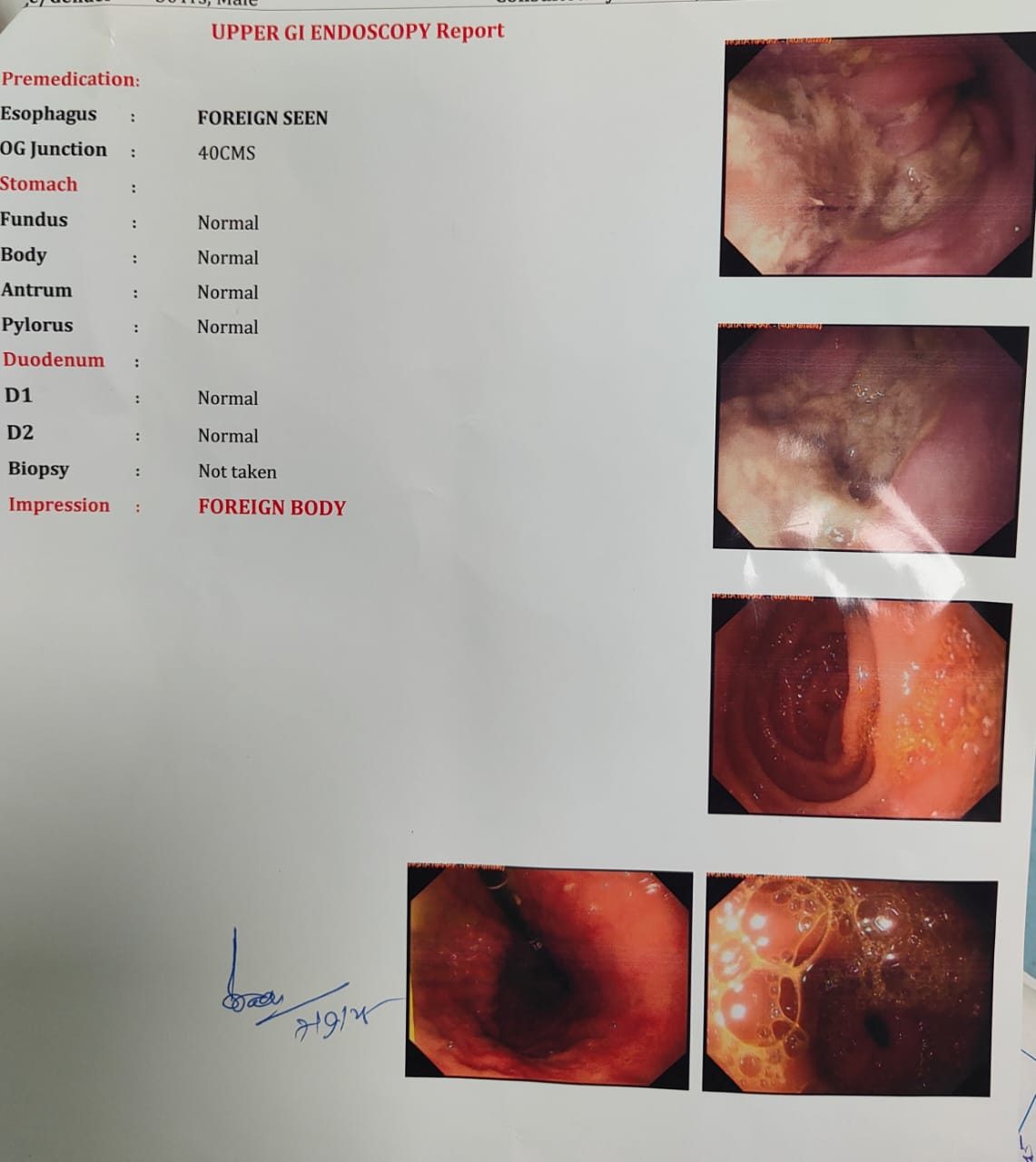 Nine-Inch ‘Tooth-Cleaning Stick’ Surgically Removed From 80-Year-Old ...