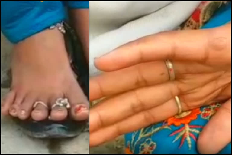Who Has 6 Toes